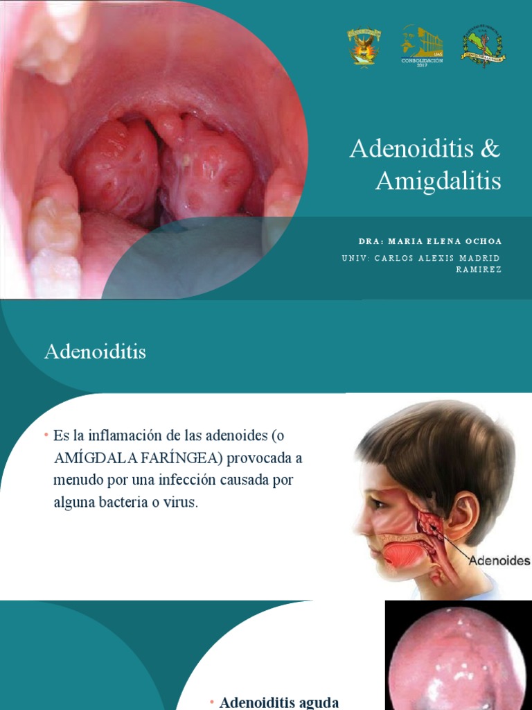 Adenoiditis y Amigdalitis | PDF | Salud y bienestar