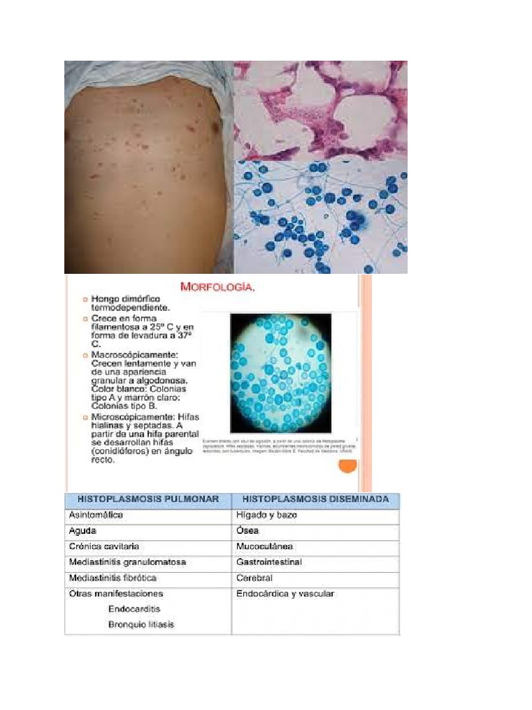 Histoplasmosis: Diagnóstico y Tratamiento | PDF