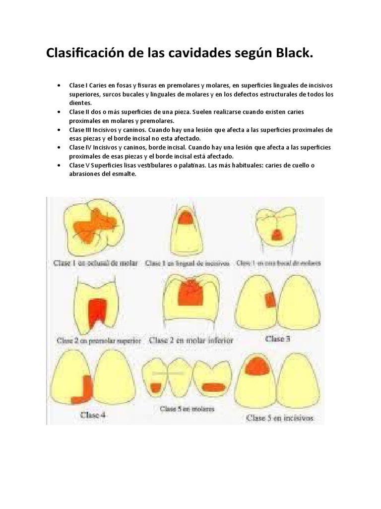 Clasificación de Las Cavidades Según Black | PDF