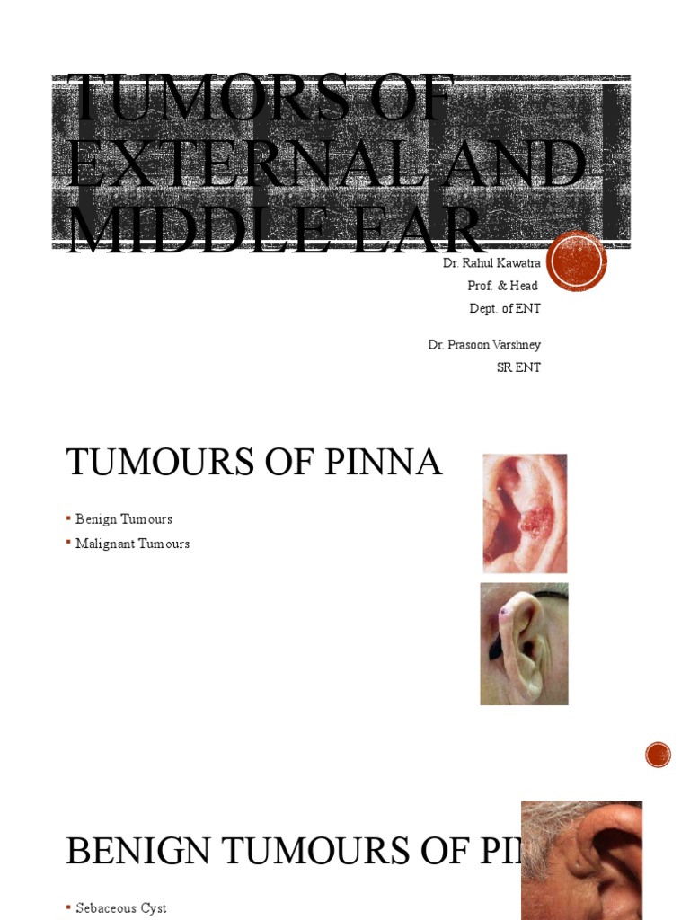 Tumors of External and Middle Ear | PDF | Ear | Metastasis