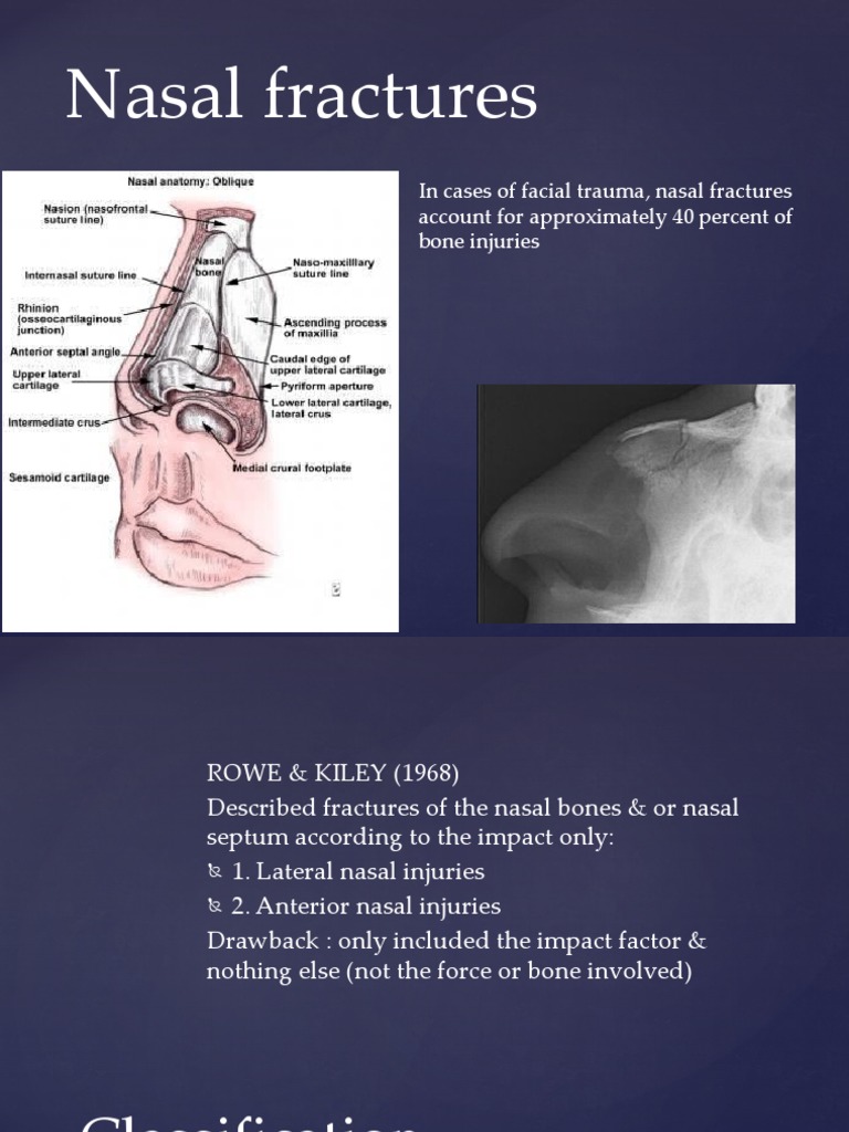 Classification and Management of Nasal Fractures | PDF | Human Nose ...