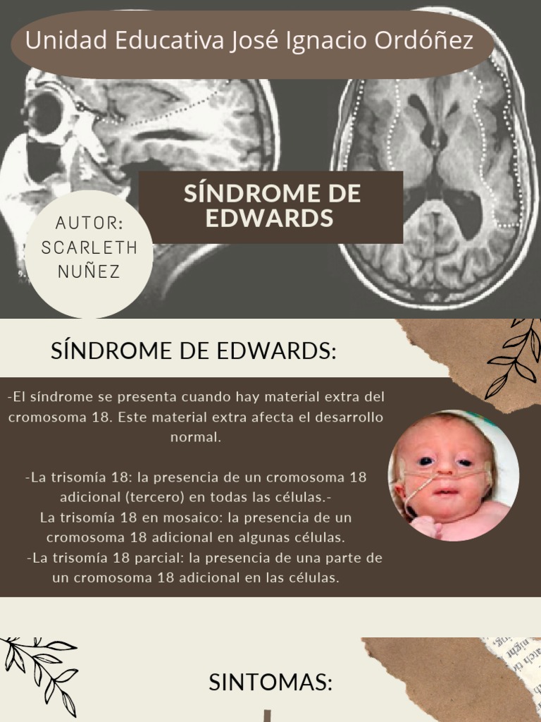 Síndrome de Edwards: Trisomía 18 y Síntomas | PDF