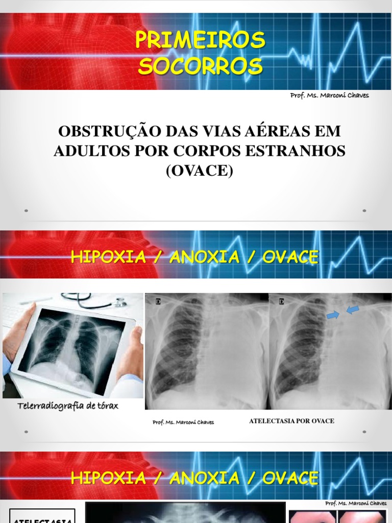 Ovace em Adultos. | PDF | Reanimação cardiopulmonar | Medicina Clínica