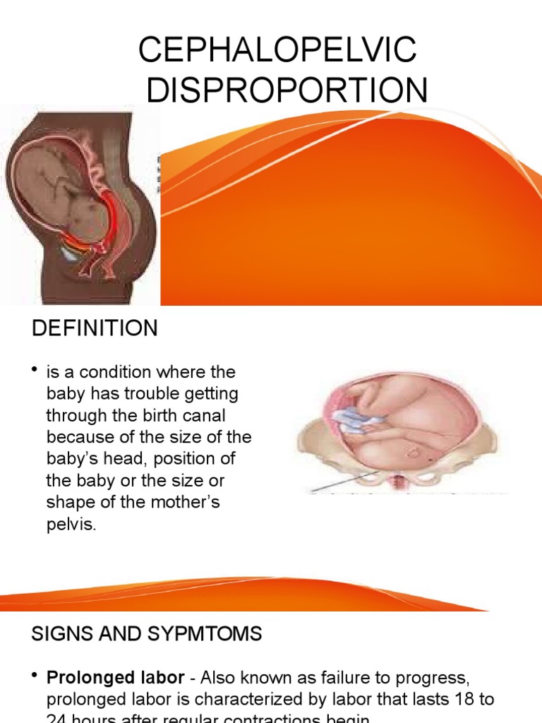 Cephalopelvic Disproportion Report | PDF | Childbirth | Pregnancy Cephalopelvic Disproportion Report | PDF | Childbirth | Pregnancy