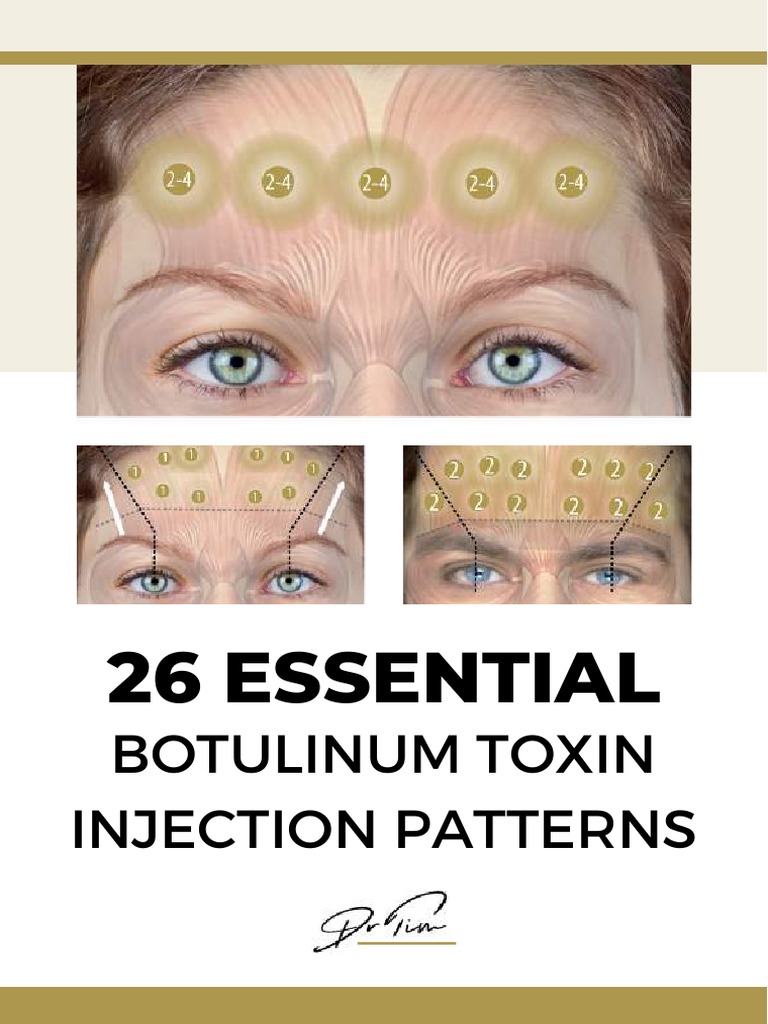 26 Essential Botulinum Toxin Injection Patterns | PDF | Botulinum Toxin ...