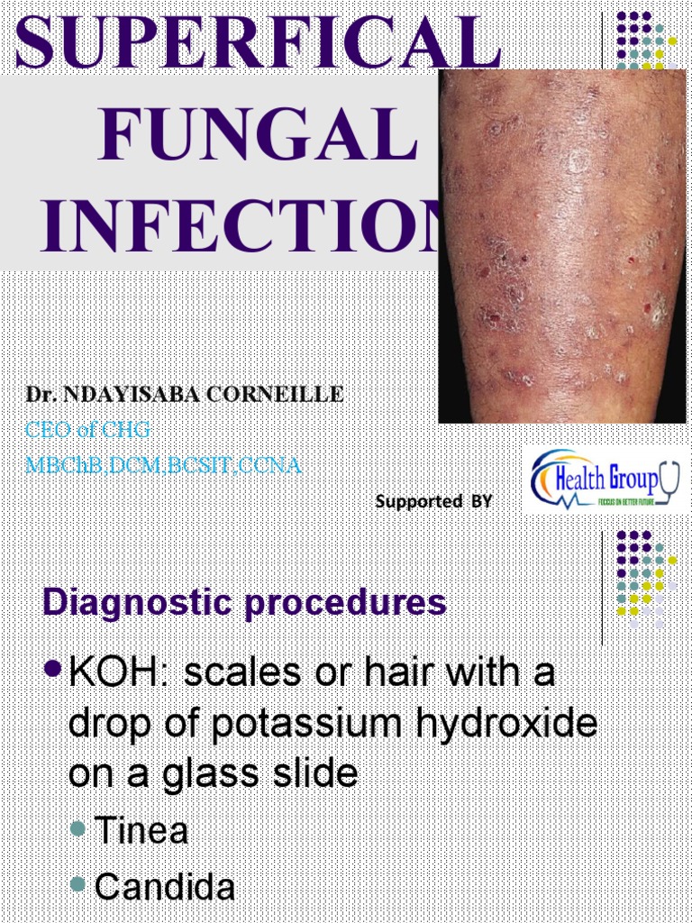 Superficial Fungal Infections | PDF | Candidiasis | Skin