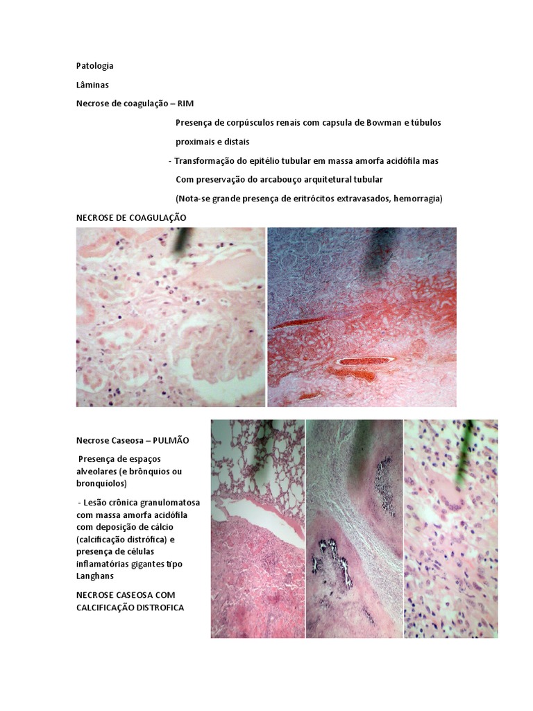 Laminas 1 | PDF | Fígado | Necrose