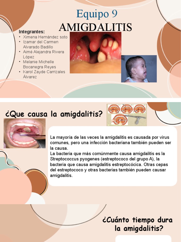 amigdalitis.pptx | PDF