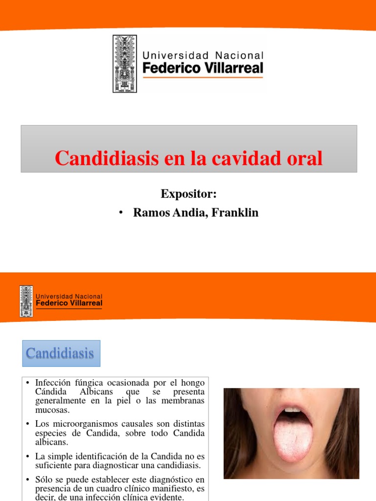 Reporte de Caso Clinico Parotiditis Viral (Vasquez Osis) - 37 | PDF ...