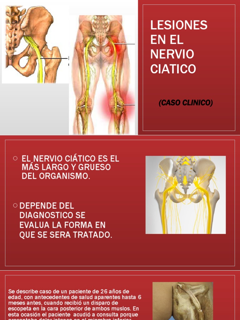 Caso Clinico LESIONES EN EL NERVIO CIATICO | PDF