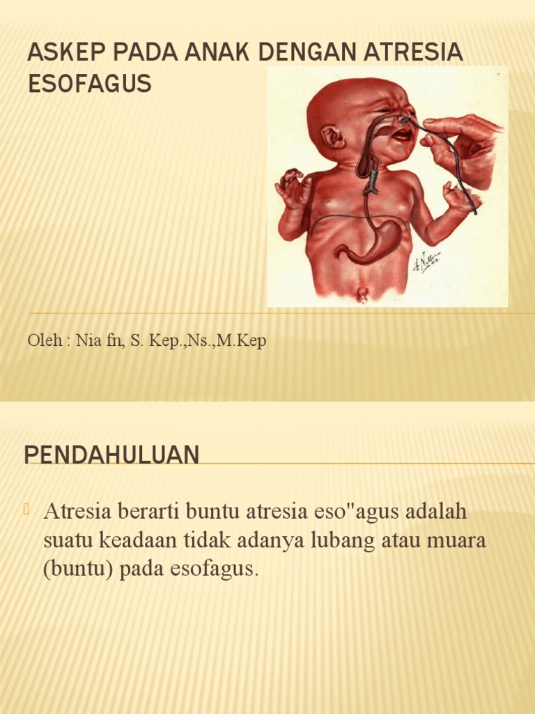 atresia esofagus | PDF