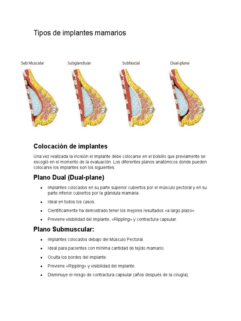 Tipos de Implantes Mamarios | PDF