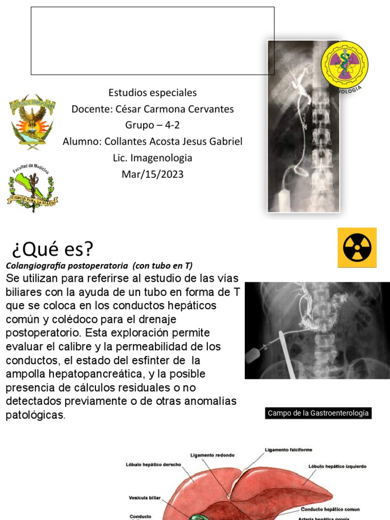 Colangiografia Por Sonda en T | PDF | Vesícula biliar | Bilis