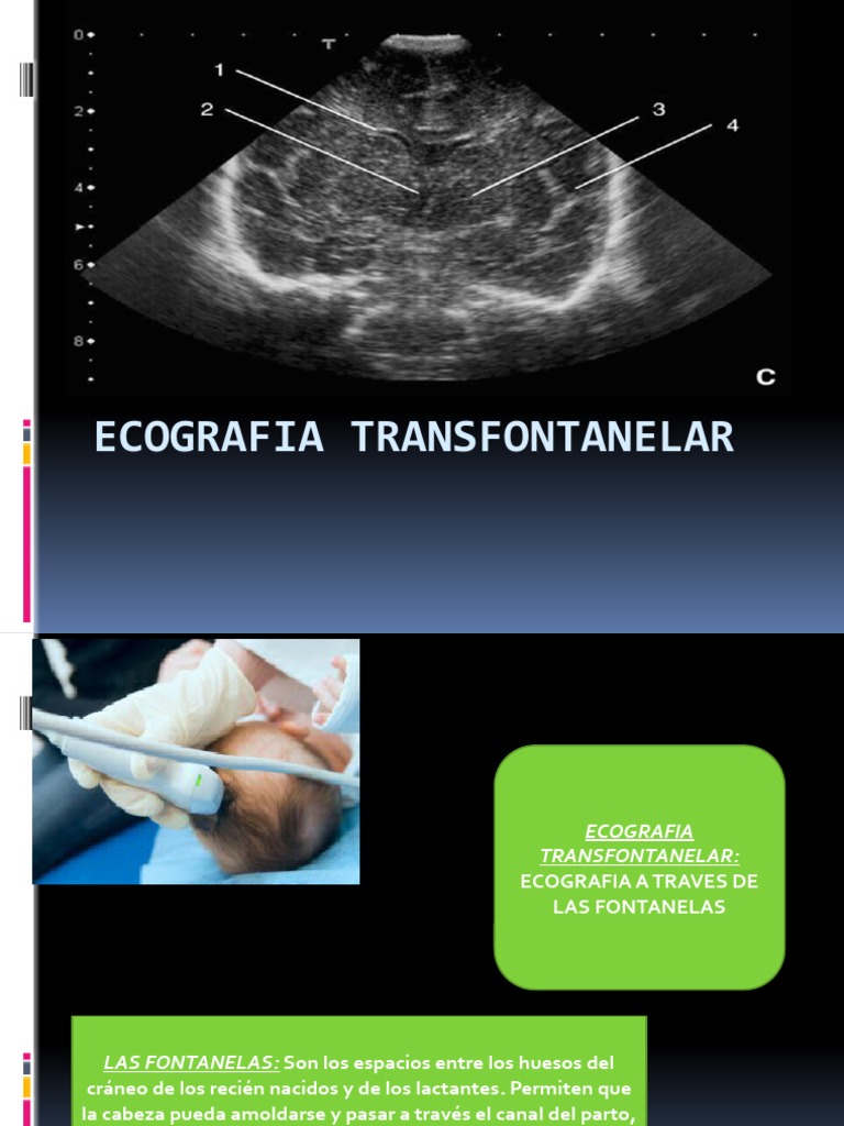 Ecografia Transfontanelar | PDF | Cráneo | Anatomía humana