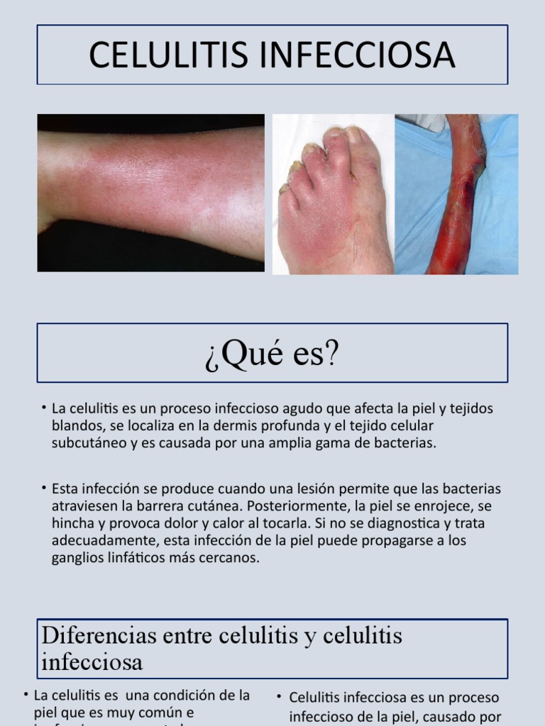Celulitis Infecciosa | PDF | Sistema inmune | Infección