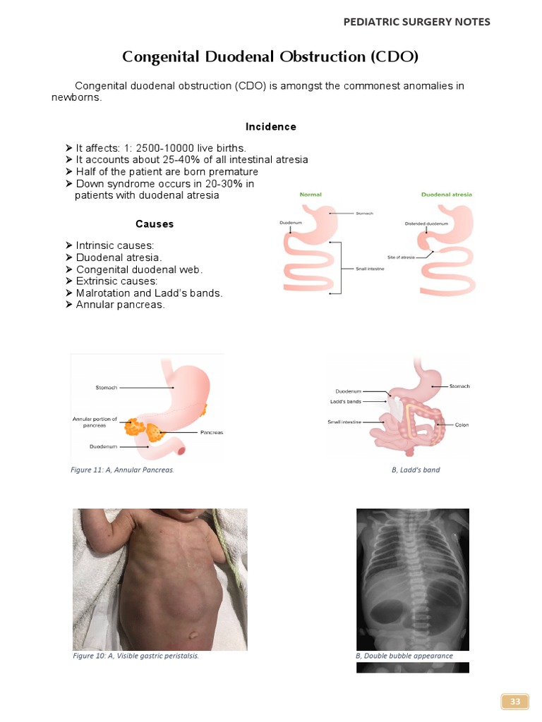 Congenital Duodenal Obstruction (CDO) | PDF | Medicine | Digestive System