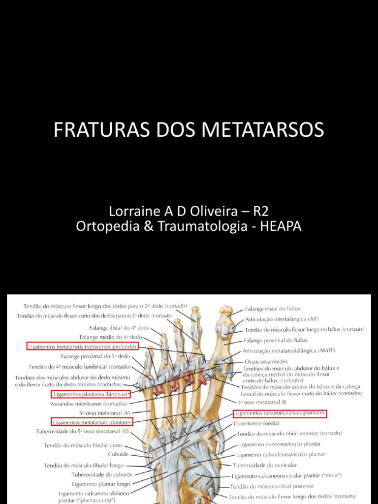 Fraturas do Quinto Metatarso: Abordagens Clínicas | PDF | Cirurgia ...