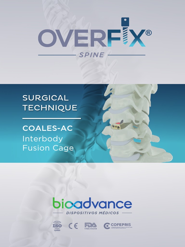 OVERFIX Spine-Surgical Technique-COALES-AC Cage | PDF | Vertebral ...