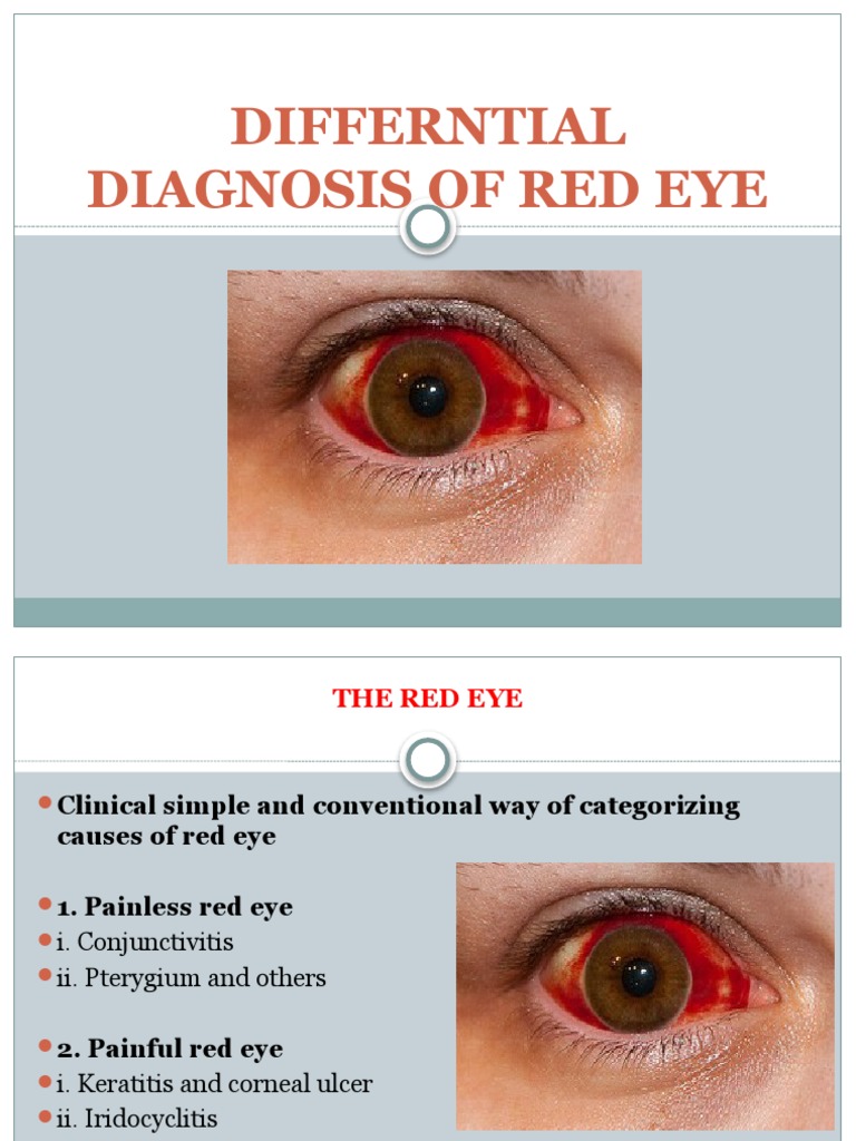 D.D of Red Eye | PDF | Cornea | Medical Specialties