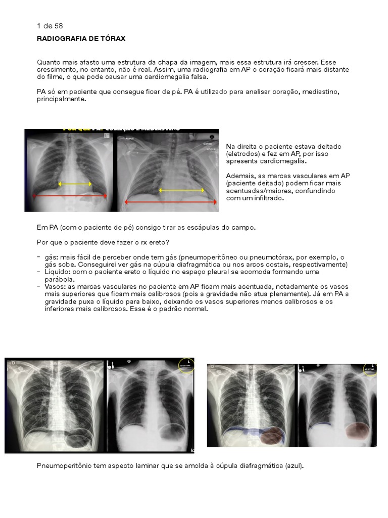 Radiografia de Tórax | PDF