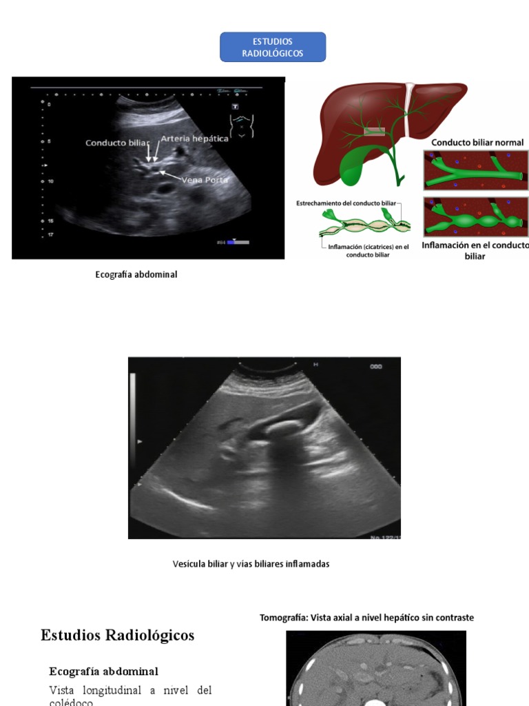 Colangitis Aguda | PDF