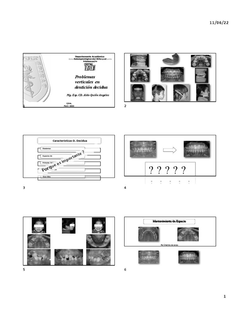 Problemas Verticales Decidua 2022 | PDF | Ortodoncia | Diente
