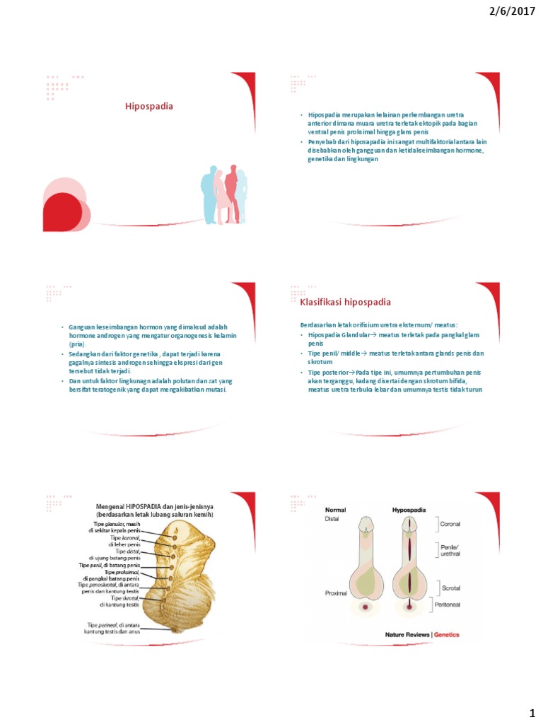 Hipospadia | PDF