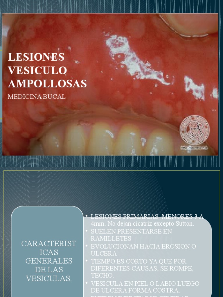 Lesiones Vesiculo Ampollosas | PDF