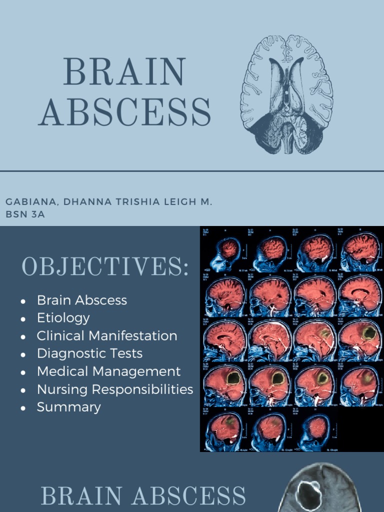 Brain Abscess | PDF