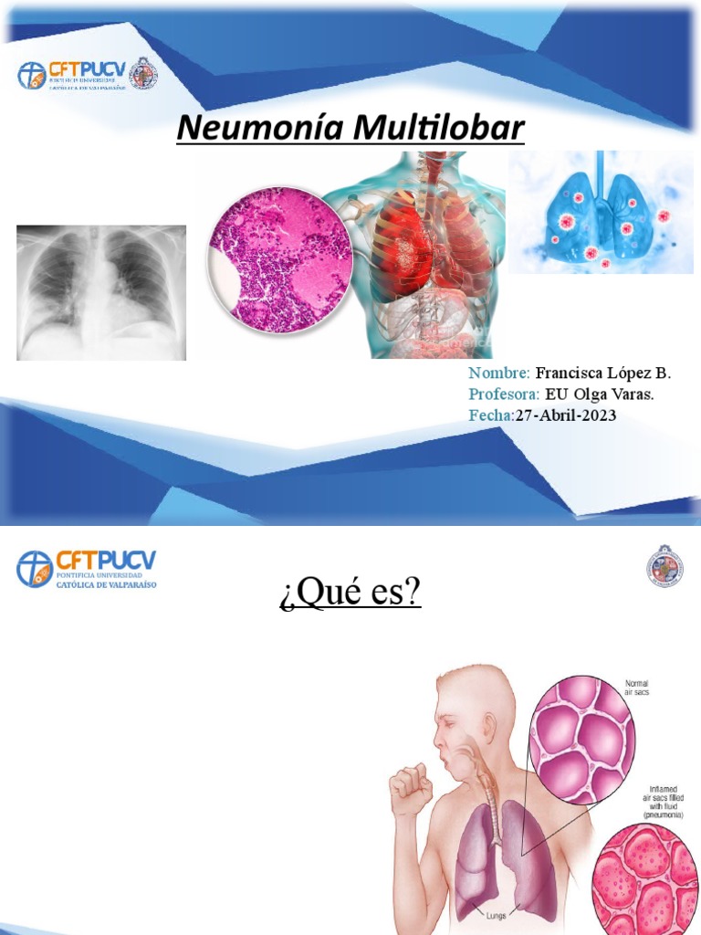 Neumonía Multilobar: Nombre: Profesora: Fecha | PDF