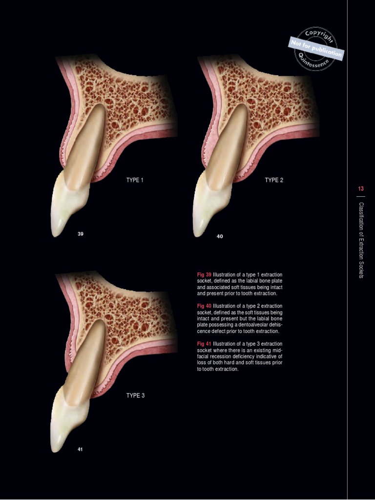 Classification of Extraction Sockets - Dennis Tarnow | PDF