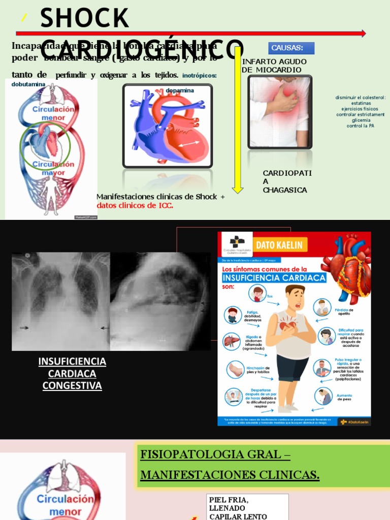 Shock Cardiogenico | PDF