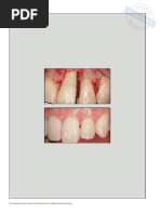 Fixos Forefoot & Mid-Foot Screw System-160420-ST-SYK-En | PDF | Screw ...