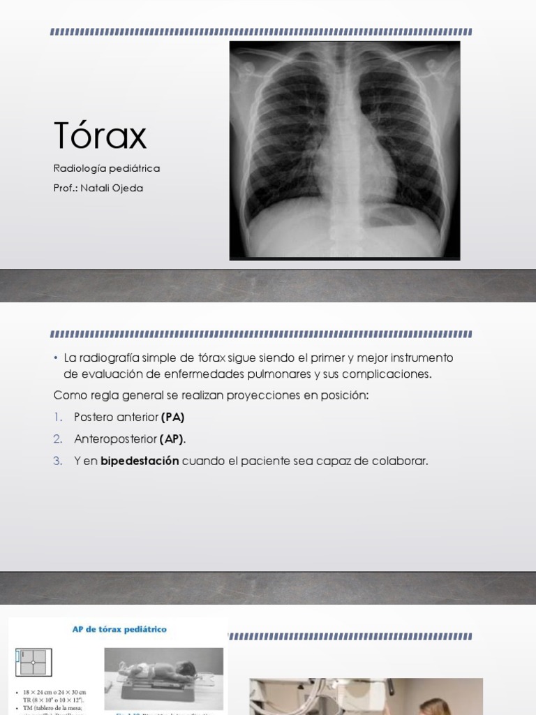 Radiografía AP de Tórax en Pediatría | PDF | Tórax | Anatomía
