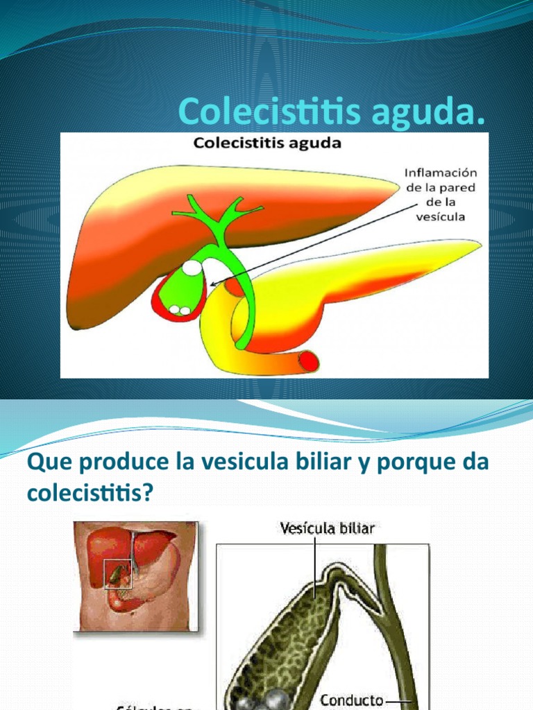 Colecistitis: Síntomas, Causas, Diagnóstico Y Tratamientos – ARJF