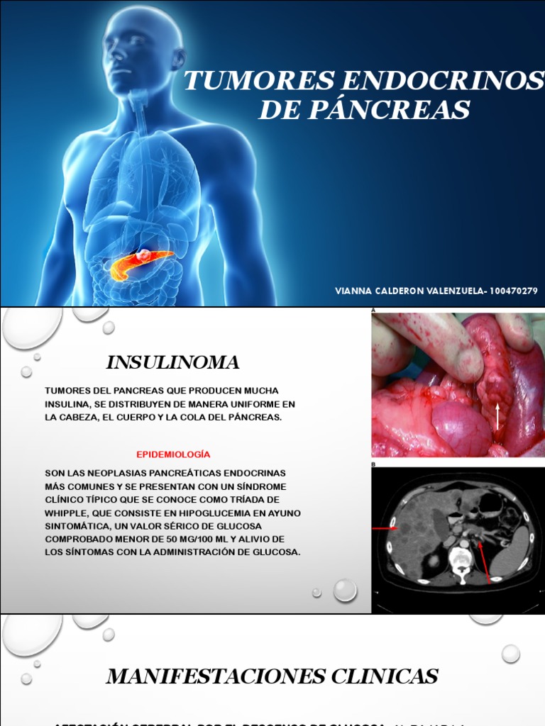 Tumores de Pancreas | PDF | Cáncer | Cáncer de páncreas