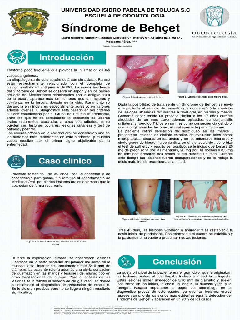 Síndrome de Behçet: Diagnóstico y Lesiones | PDF | Diagnostico medico ...