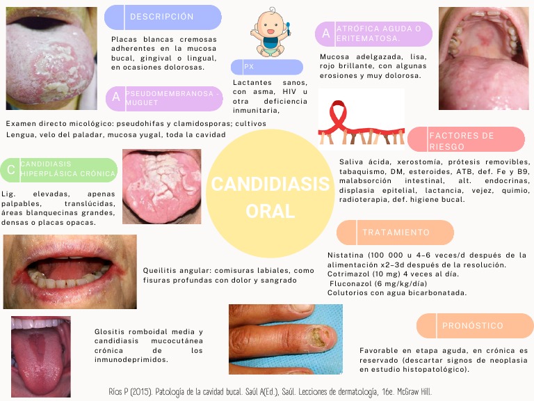 Candidiasis Oral | PDF | Candidiasis | Medicina CLINICA