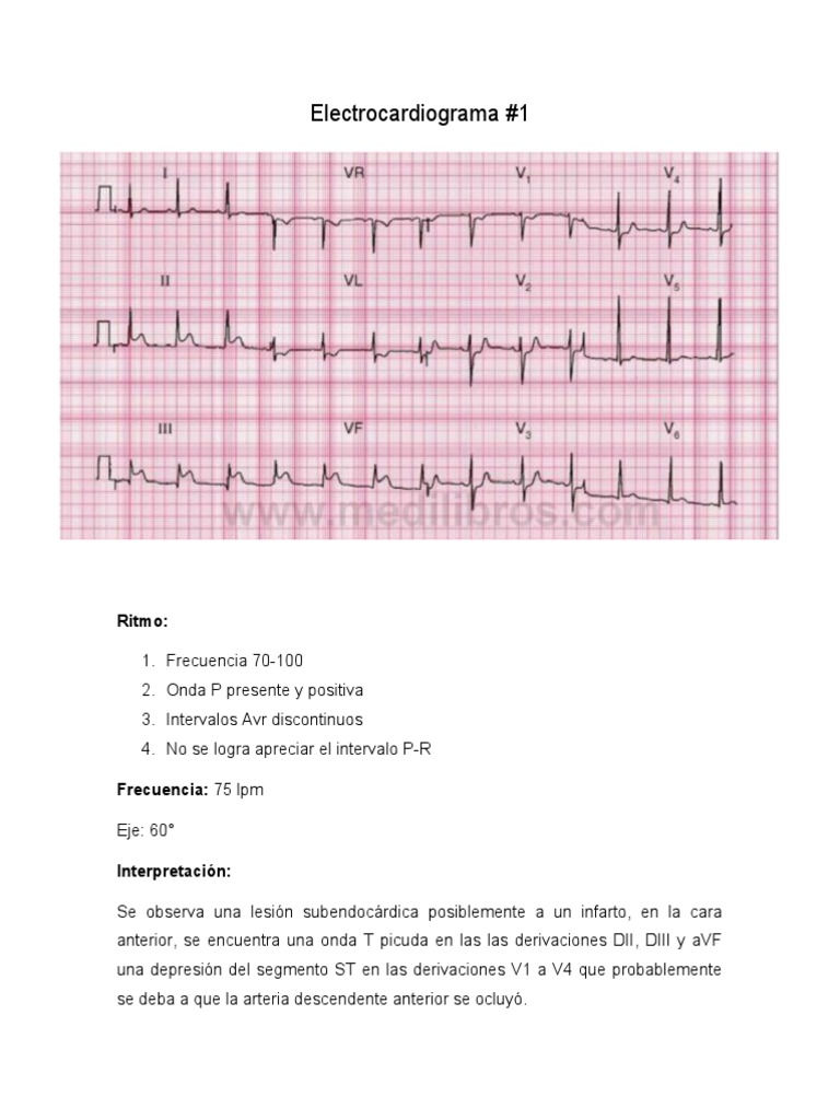 Análisis de Electrocardiogramas y Prueba de Resistencia | PDF