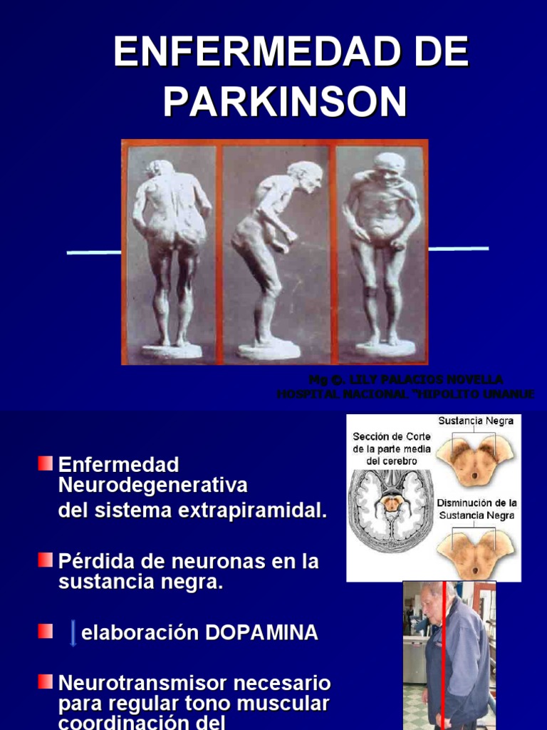 Postura Simiesca en Parkinson | PDF | Enfermedad de Parkinson ...