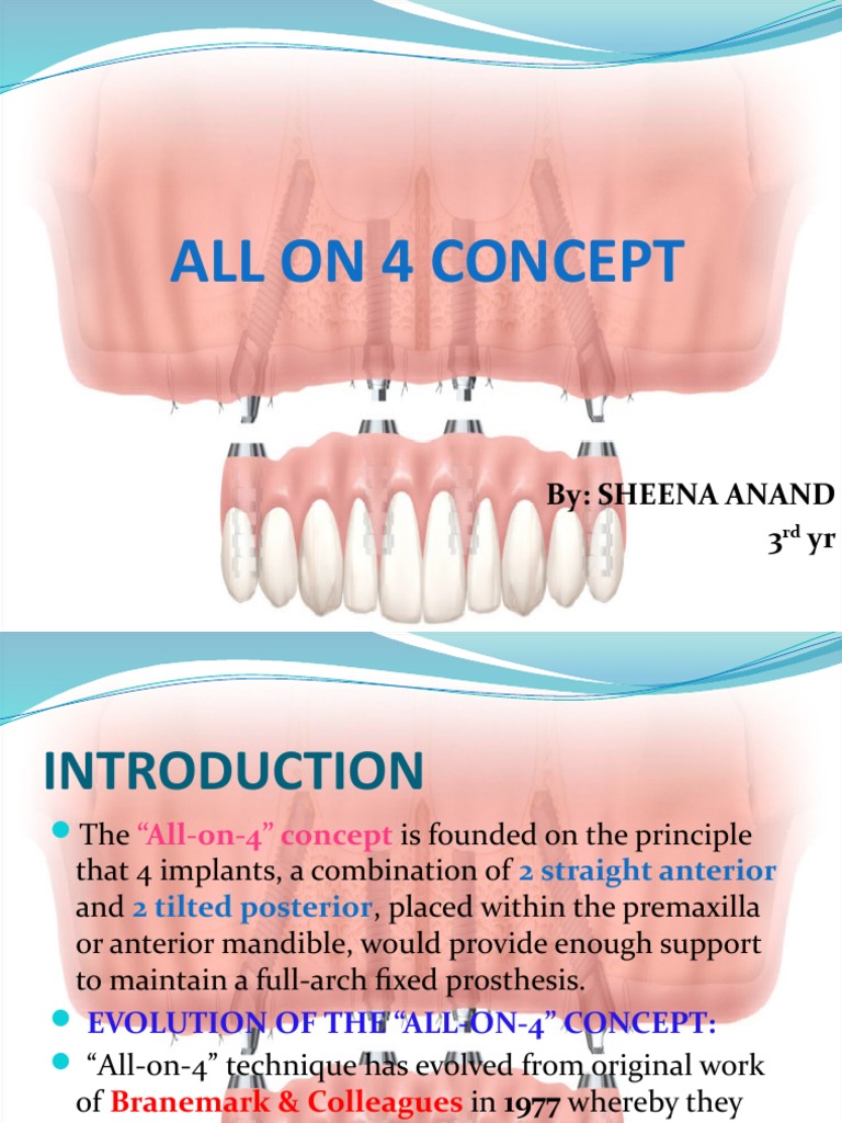 All On 4 Concept | PDF | Dental Implant | Dentures