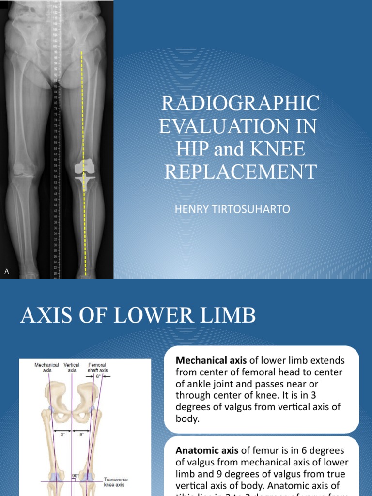 Radiographic Evaluation in Hip and Knee Replacement - HNR | PDF | Knee | Hip