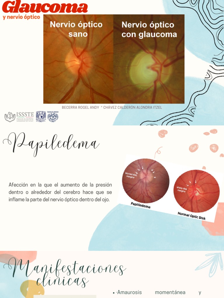 Glaucoma y Nervio Optico | PDF | Glaucoma | Córnea