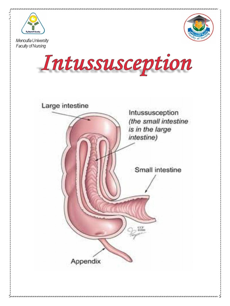 Intussusception | PDF | Causes Of Death | Medical Specialties