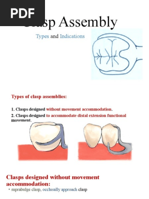Types Of Clasps In Partial Denture
