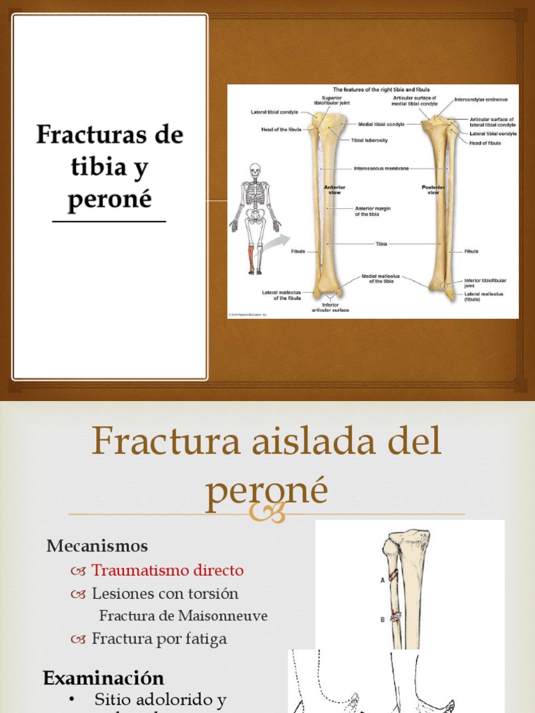 C - 13 Fract Tibia y Perone | PDF | Rodilla | Traumatologia