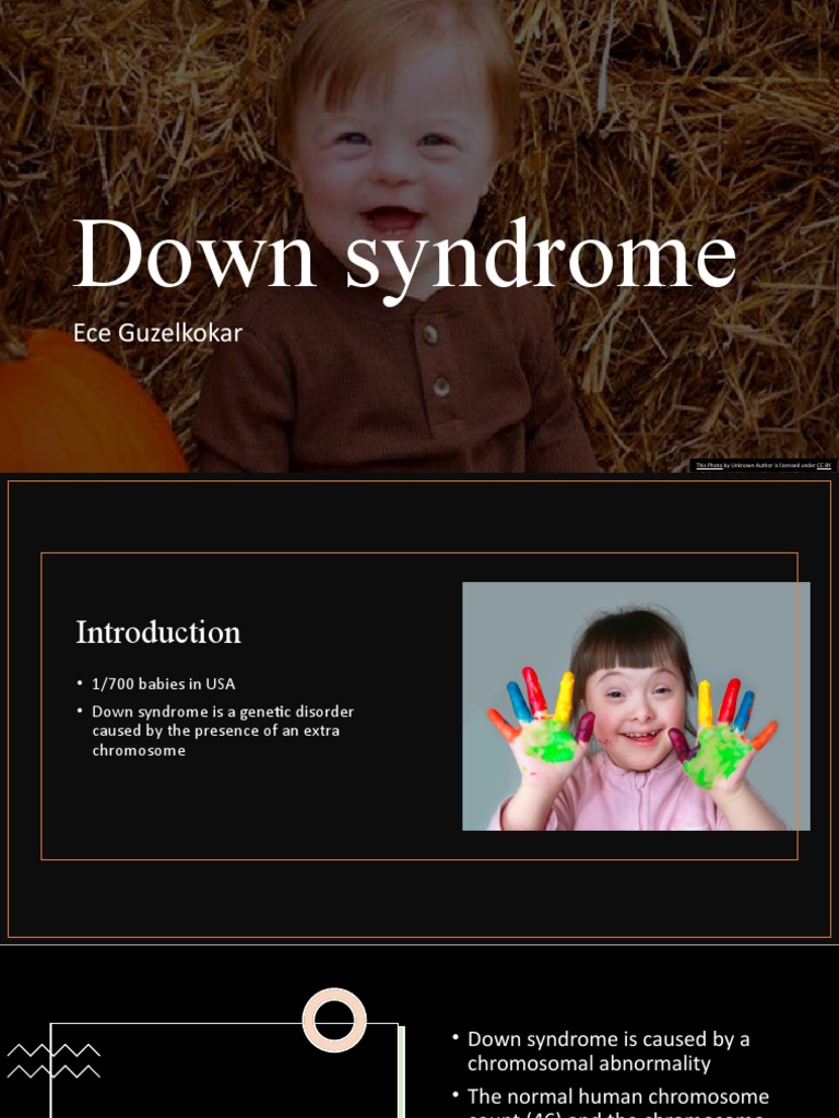Understanding Down Syndrome | PDF