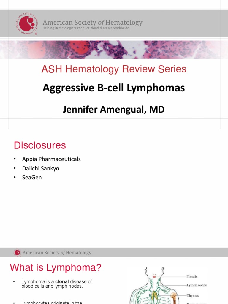 2022 HRS - Aggressive B-Cell Lymphomas FINAL | PDF | Lymphoma | Hepatitis B
