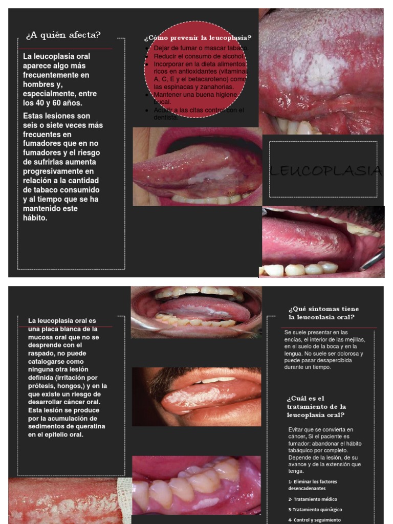 Leucoplasia Oral: Síntomas y Tratamiento | PDF