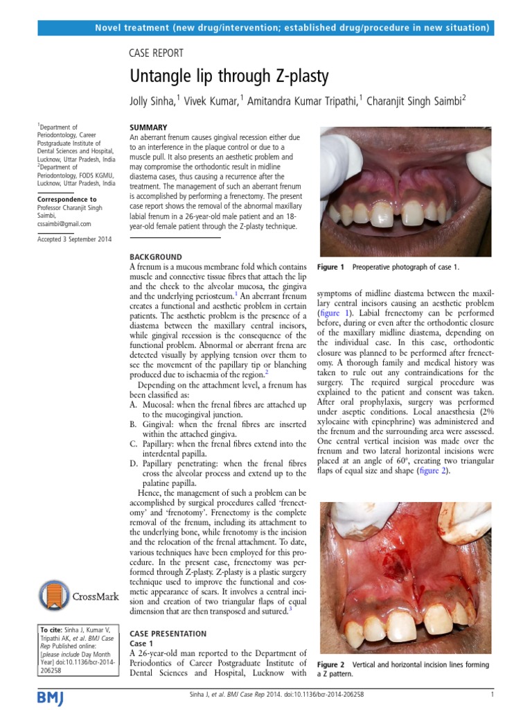 Frenectomy Z Plasty | PDF | Periodontology | Surgery